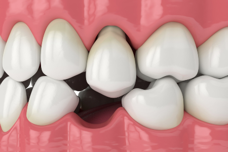 Missing Teeth? Prevent Shift & Drift! | Tracy Dental Excellence | Tracy, CA